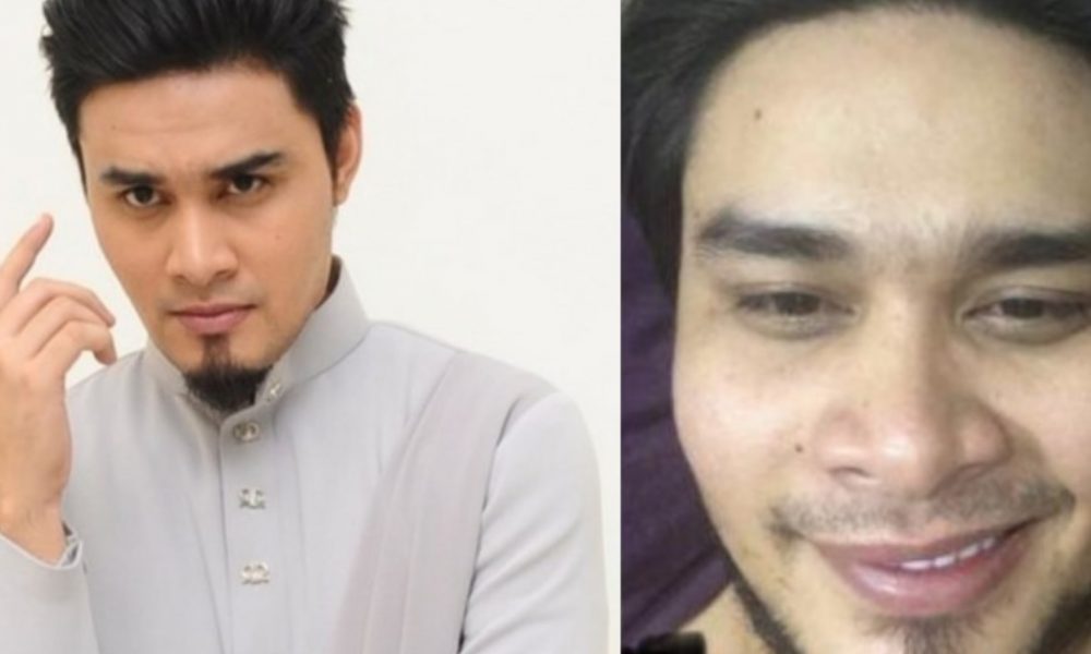 Muka Bengkak & Bernanah, Netizen Risau Keadaan Shahir