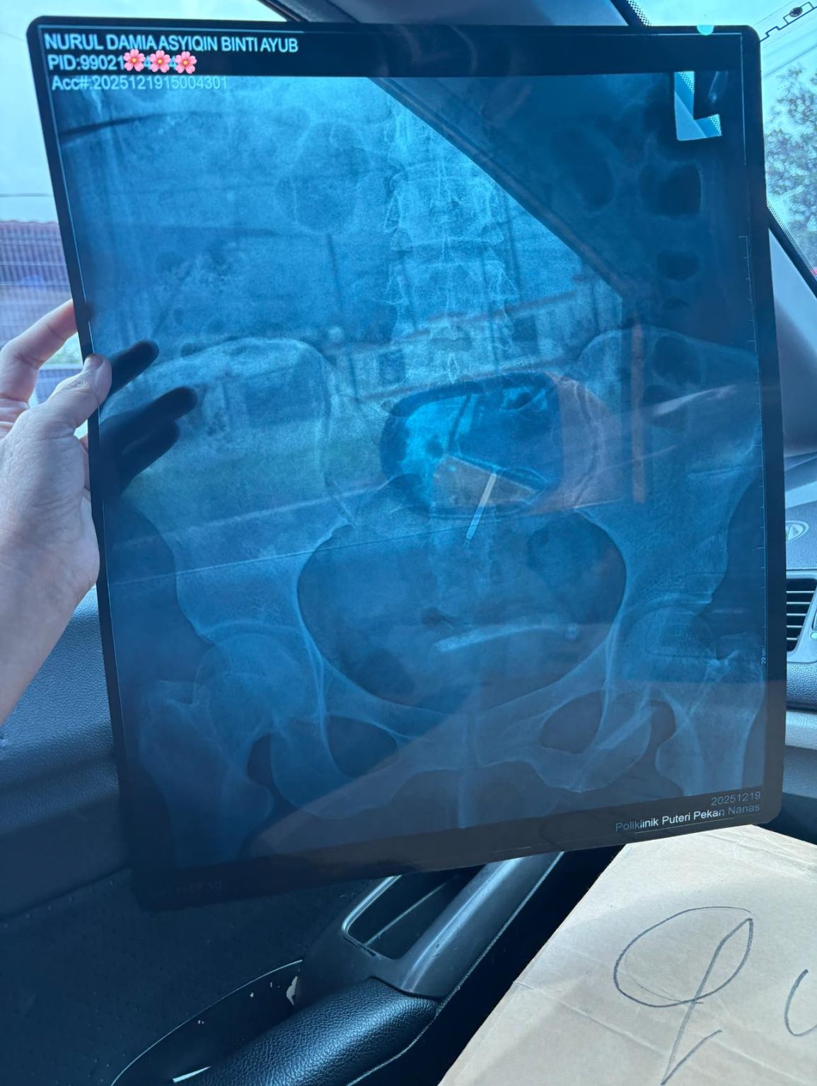 Doktor Pasang IUCD Sehingga Tembus Rahim, Wanita Tak Boleh Beranak ...